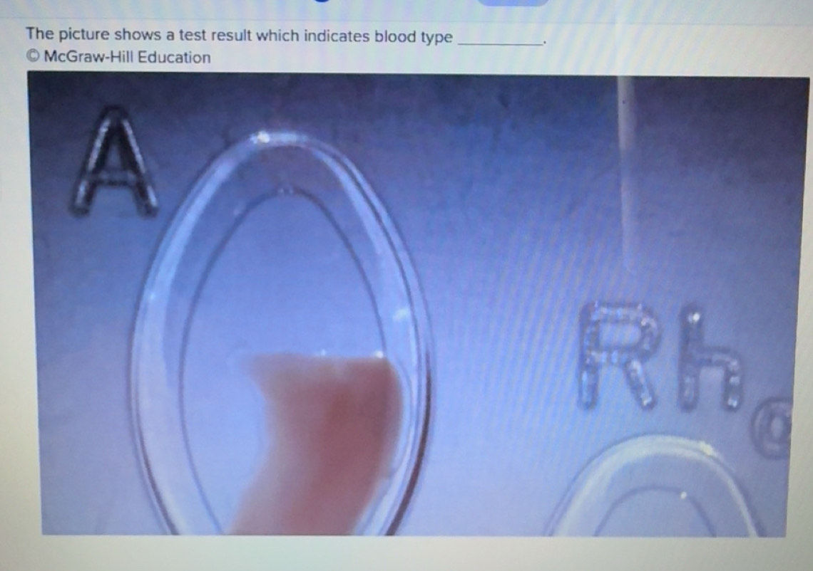 Solved: The picture shows a test result which indicates blood type ...