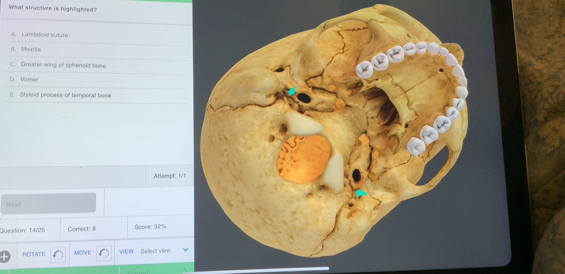 Solved: What structure is highlighted? A. Lambdoid suture I. Maxilta C ...