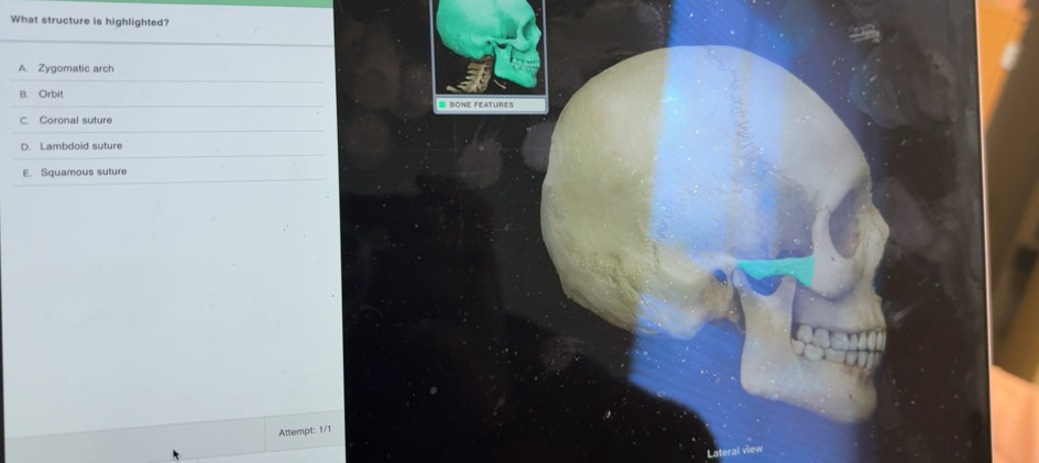 Solved: What structure is highlighted? A. Zygomatic arch B Orbit = BONE ...