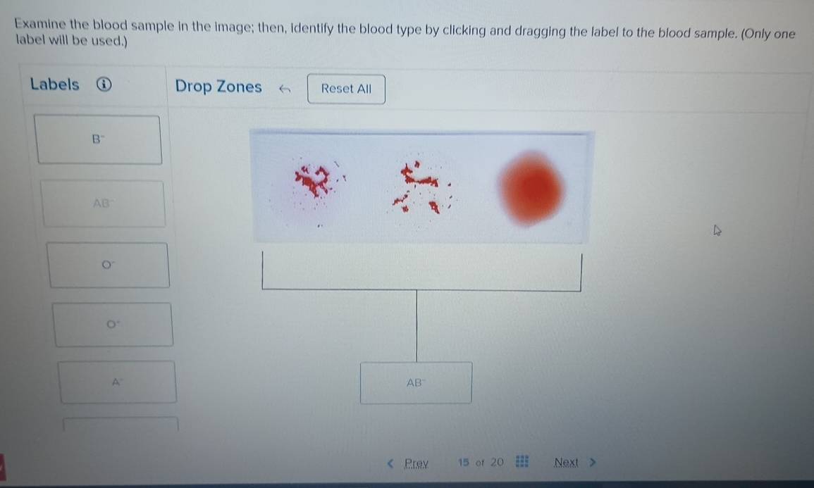 Solved: Examine the blood sample in the image; then, identify the blood ...