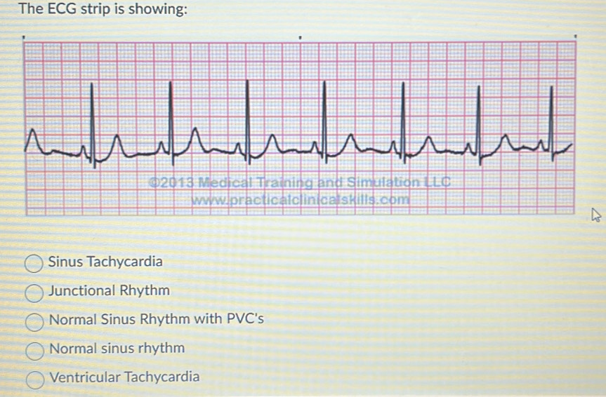 Solved: The ECG strip is showing: Sinus Tachycardia Junctional Rhythm ...
