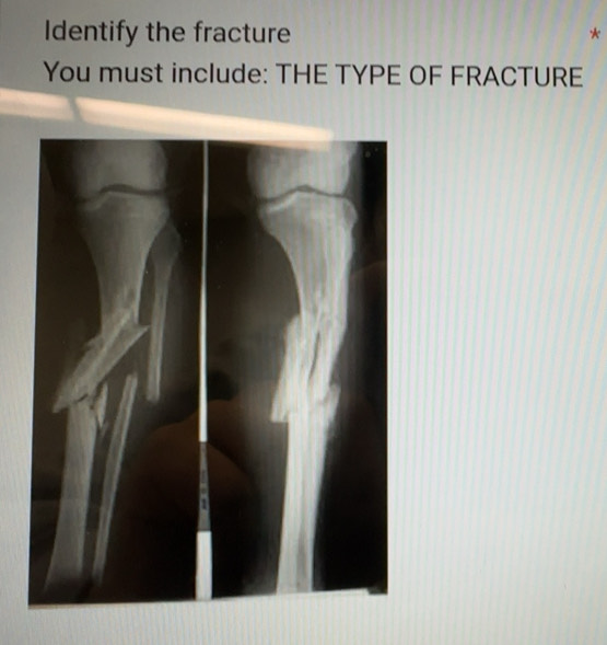 Gelöst:Identify the fracture You must include: THE TYPE OF FRACTURE
