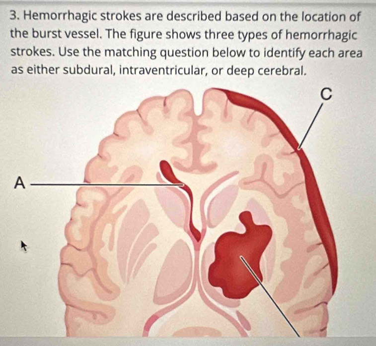 Solved: Hemorrhagic strokes are described based on the location of the ...