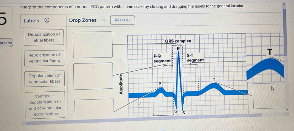 Solved: Interpret the components of a normal ECG pattern with a time ...