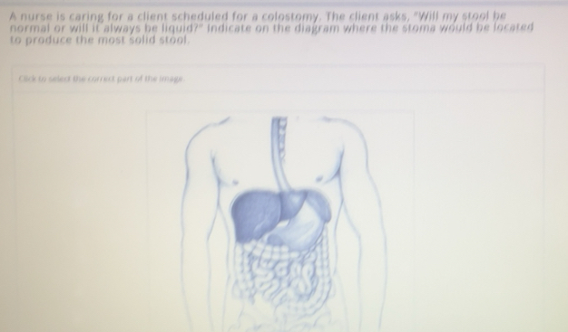 Solved: A nurse is caring for a client scheduled for a colostomy. The ...