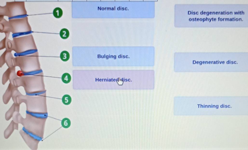 Solved: 1 Normal disc. Disc degeneration with osteophyte formation. 2 3 ...